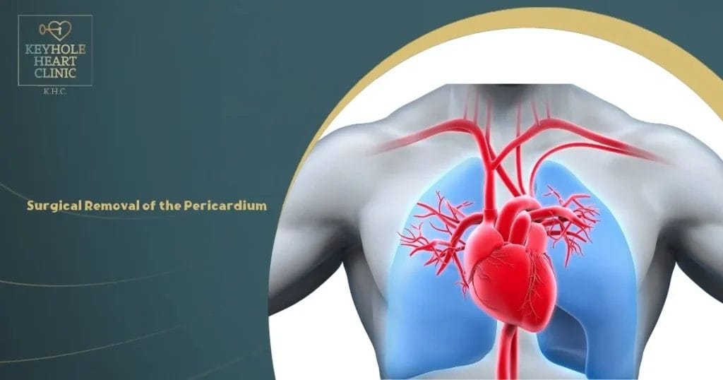 Surgical Removal of the Pericardium