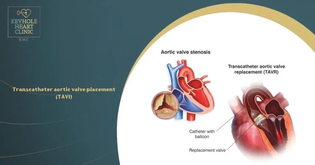Transcatheter aortic valve placement (TAVI)
